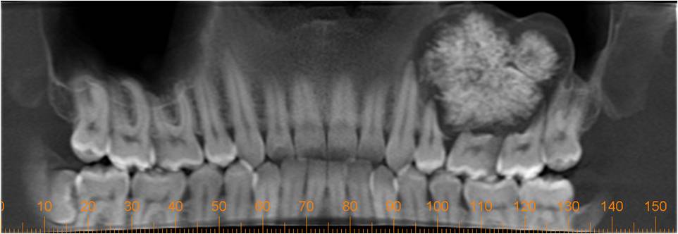 Tumores odontogénicos: preguntas y respuestas - ALSER DENTAL